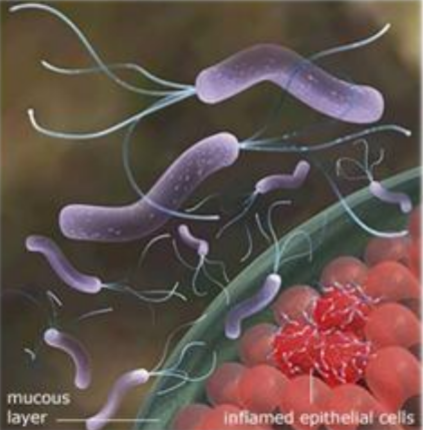 Peptic ulcers - Biology Ease