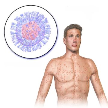 Varicella Zoster Virus: Understanding the Cause Behind Chickenpox and ...