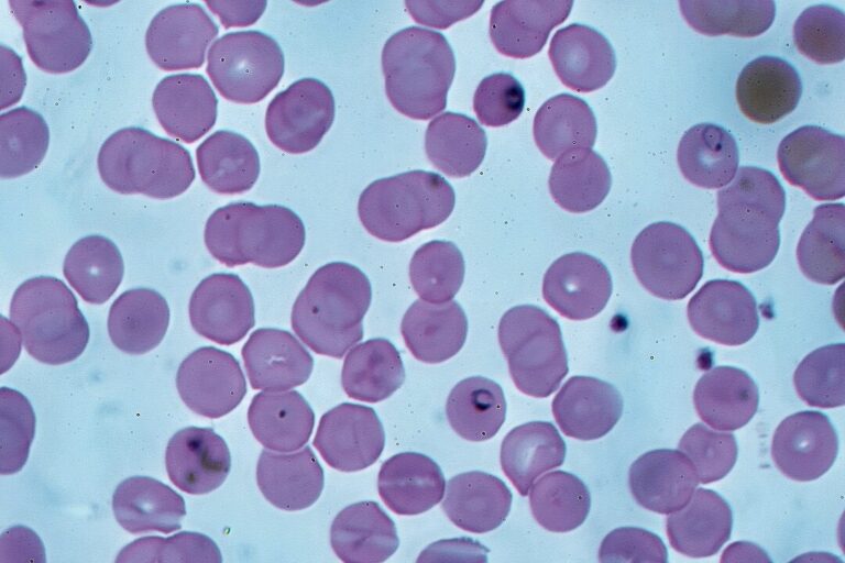 Plasmodium falciparum: Causes, Symptoms, Treatment, and Prevention of ...