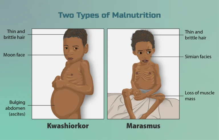 Malnutrition: Deficiencies and Over Consumption - Biology Ease